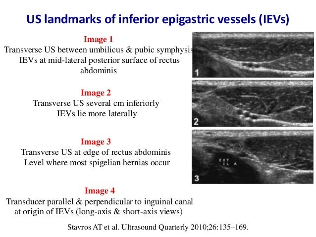Inferior Epigastric Artery Hernia