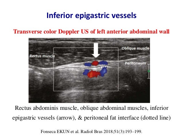Ultrasound of groin & anterior abdominal wall hernias