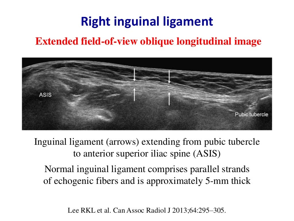 Ultrasound of groin & anterior abdominal wall hernias