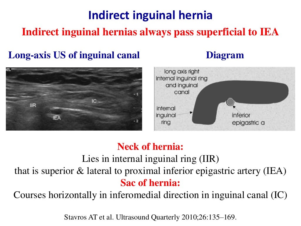 Ultrasound of groin & anterior abdominal wall hernias