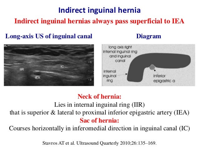 Ultrasound of groin & anterior abdominal wall hernias