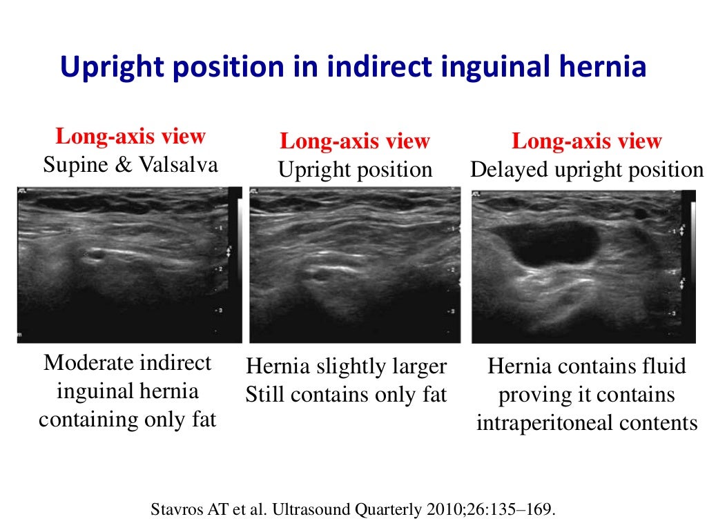 Ultrasound of groin & anterior abdominal wall hernias