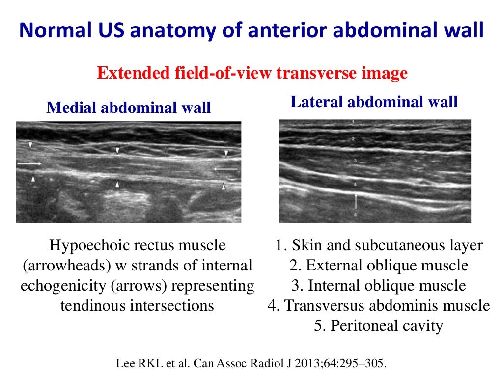 Ultrasound of groin & anterior abdominal wall hernias