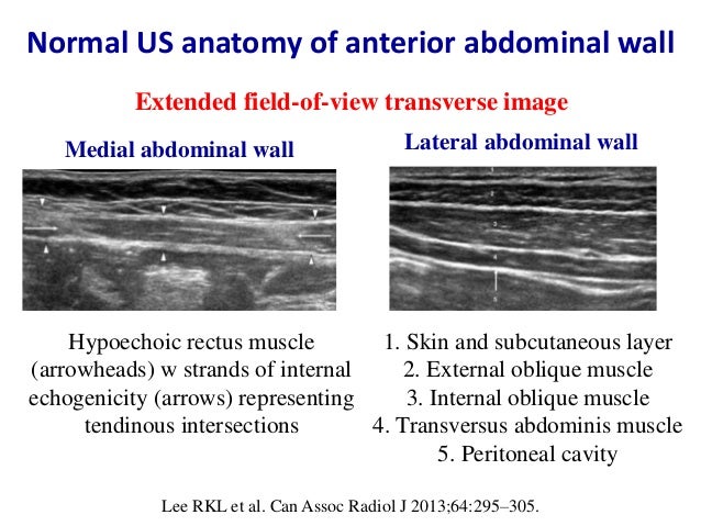Ultrasound of groin & anterior abdominal wall hernias