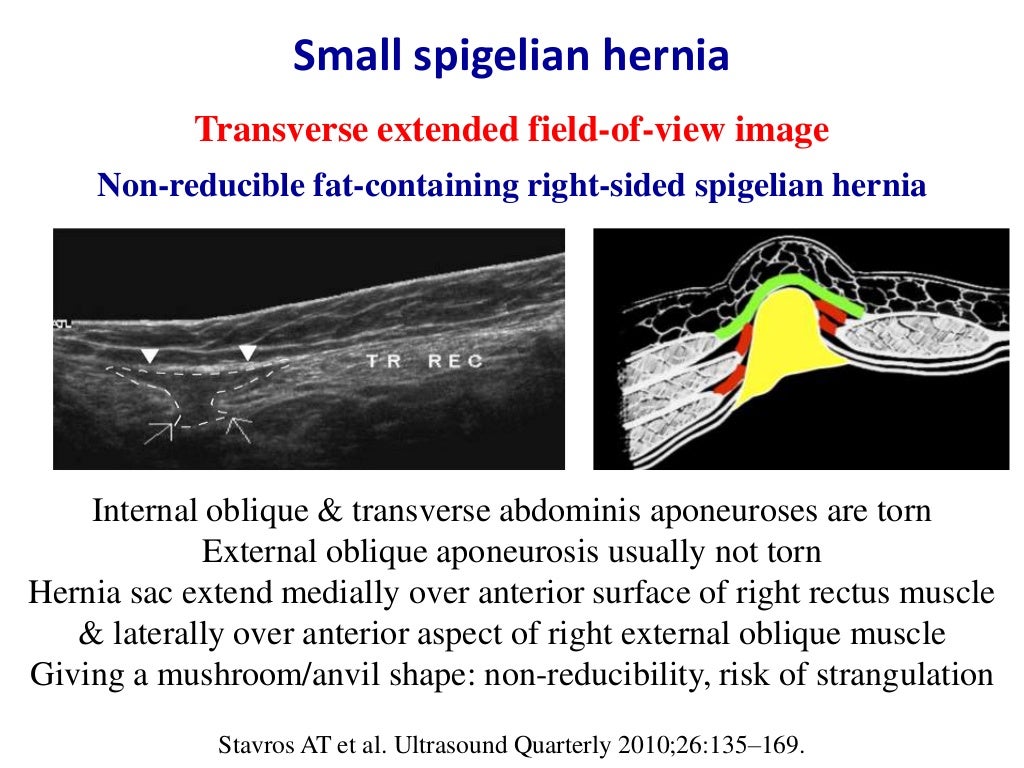 Ultrasound of groin & anterior abdominal wall hernias