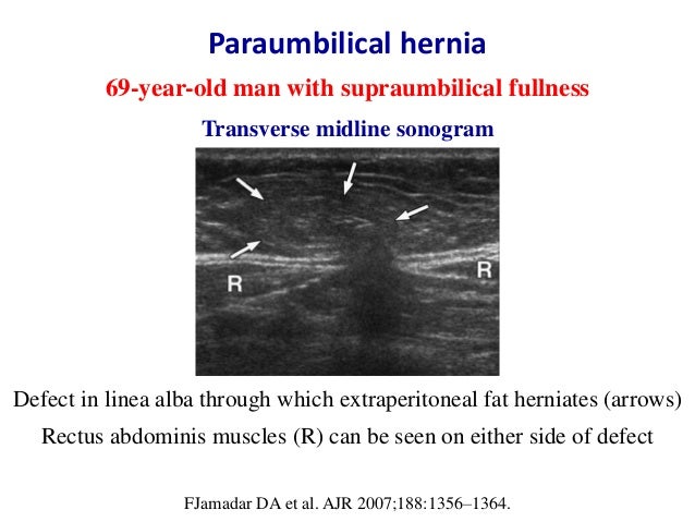 Linea Alba Hernia