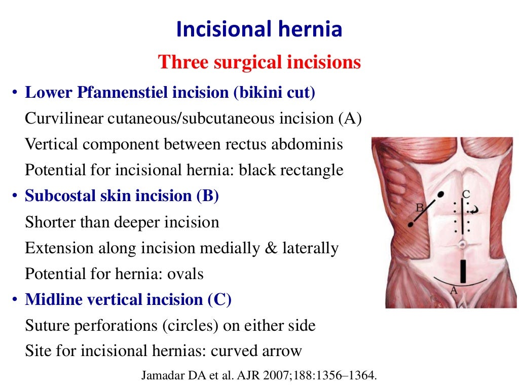 Ultrasound of groin & anterior abdominal wall hernias