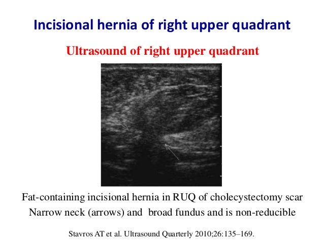 Ultrasound of groin & anterior abdominal wall hernias