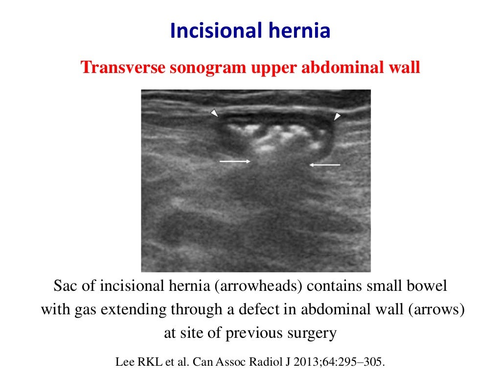 Ultrasound of groin & anterior abdominal wall hernias