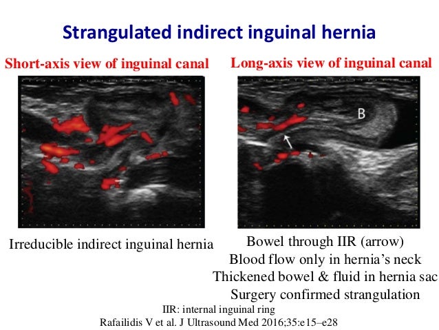 Ultrasound of groin & anterior abdominal wall hernias