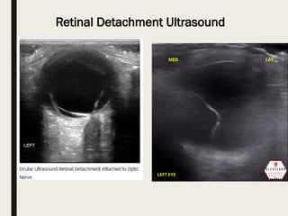 ULTRASOUND OF ORBIT & EYE- radiology description | PPTX