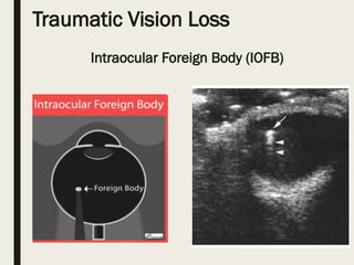 ULTRASOUND OF ORBIT & EYE- radiology description | PPTX