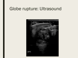 ULTRASOUND OF ORBIT & EYE- radiology description | PPTX