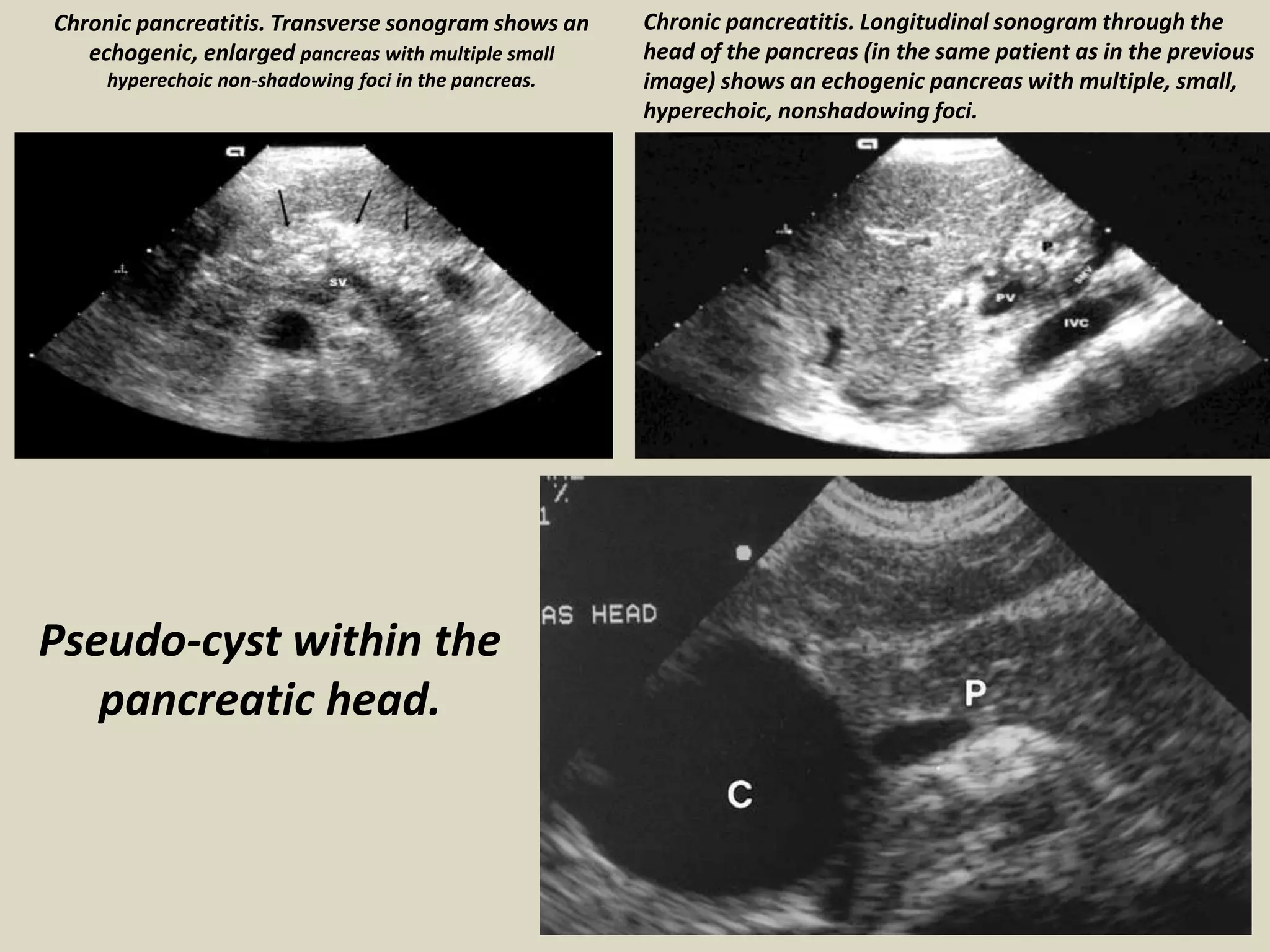 Ultrasound of pancrease in Radiology | PPTX