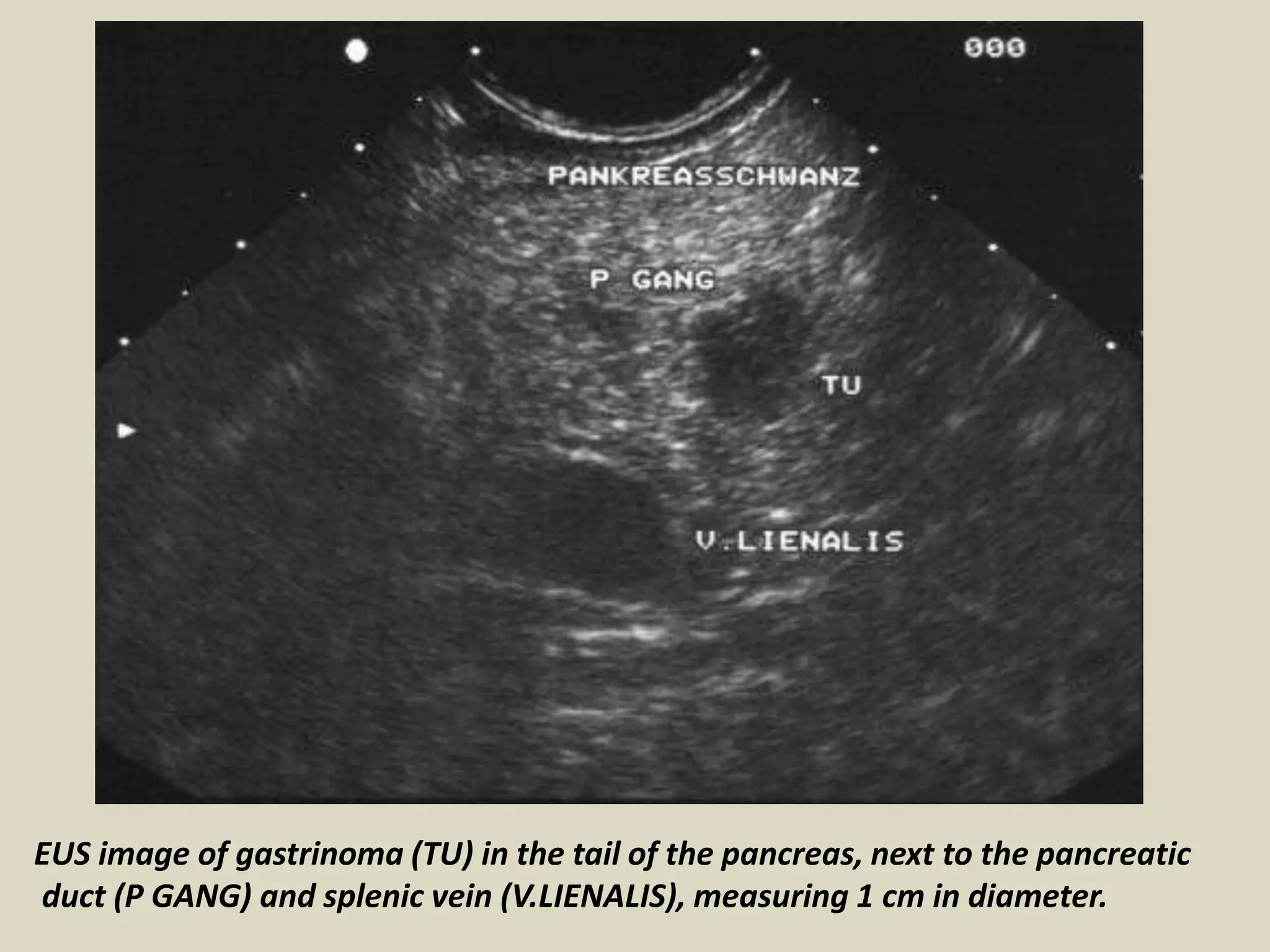 Ultrasound of pancrease in Radiology | PPTX