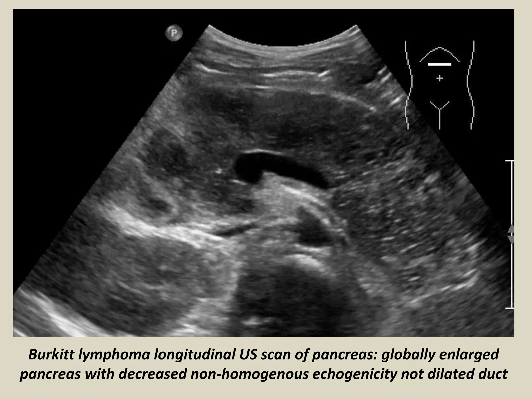 Ultrasound of pancrease in Radiology | PPTX