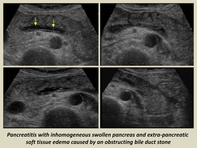 Ultrasound of pancrease in Radiology | PPTX | Digestive Disorders ...