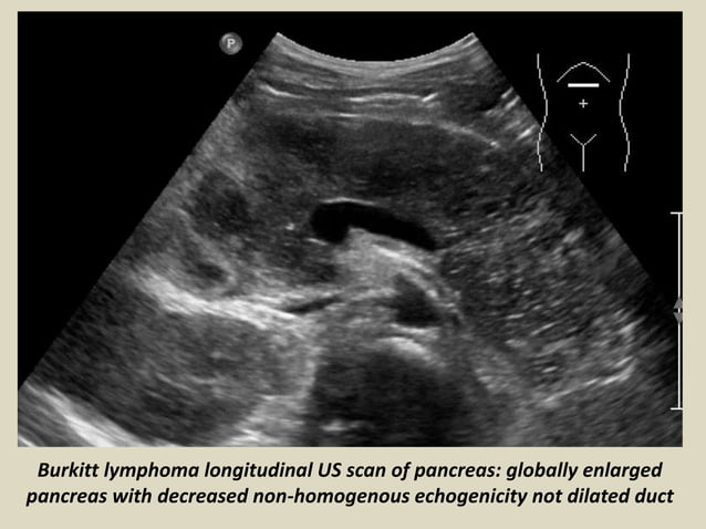 Ultrasound of pancrease in Radiology | PPTX | Digestive Disorders ...