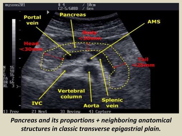 Ultrasound of pancrease in Radiology | PPTX | Digestive Disorders ...