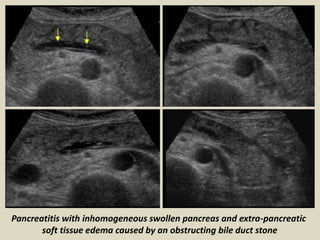 Abnormal Pancreas Ultrasound