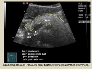 Pancreatic Duct Ultrasound