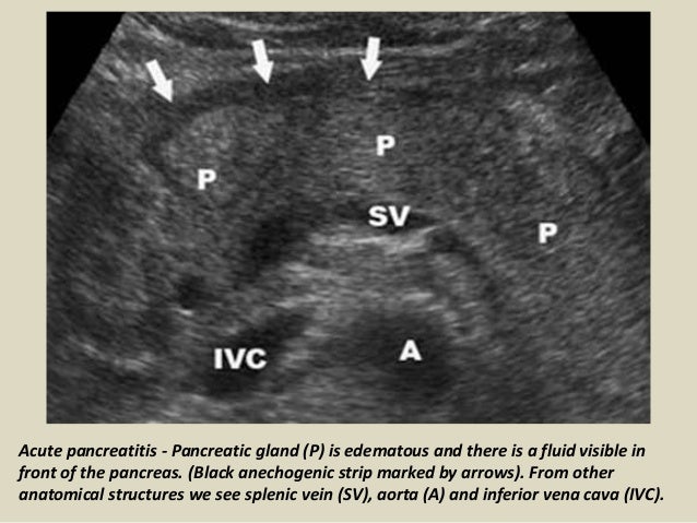 Ultrasound of pancrease in Radiology
