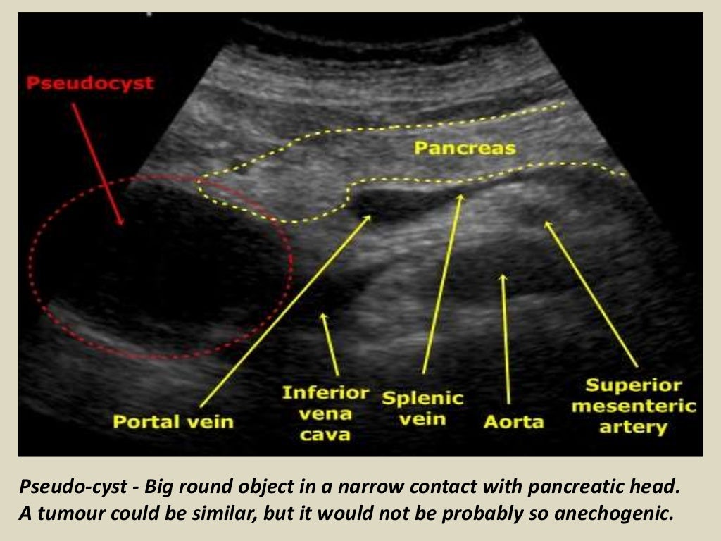 Ultrasound of pancrease in Radiology