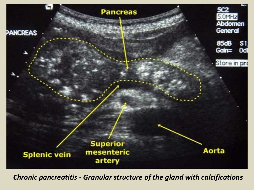 Ultrasound of pancrease in Radiology
