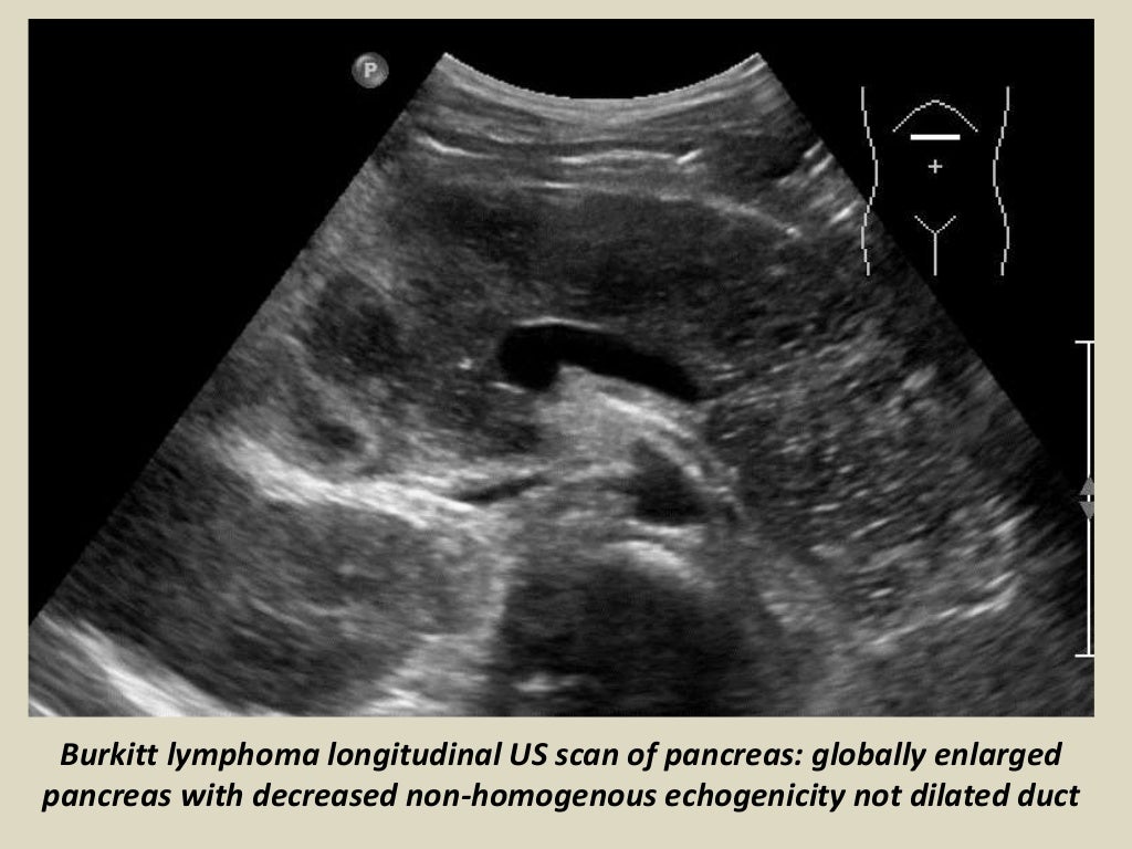 Ultrasound of pancrease in Radiology