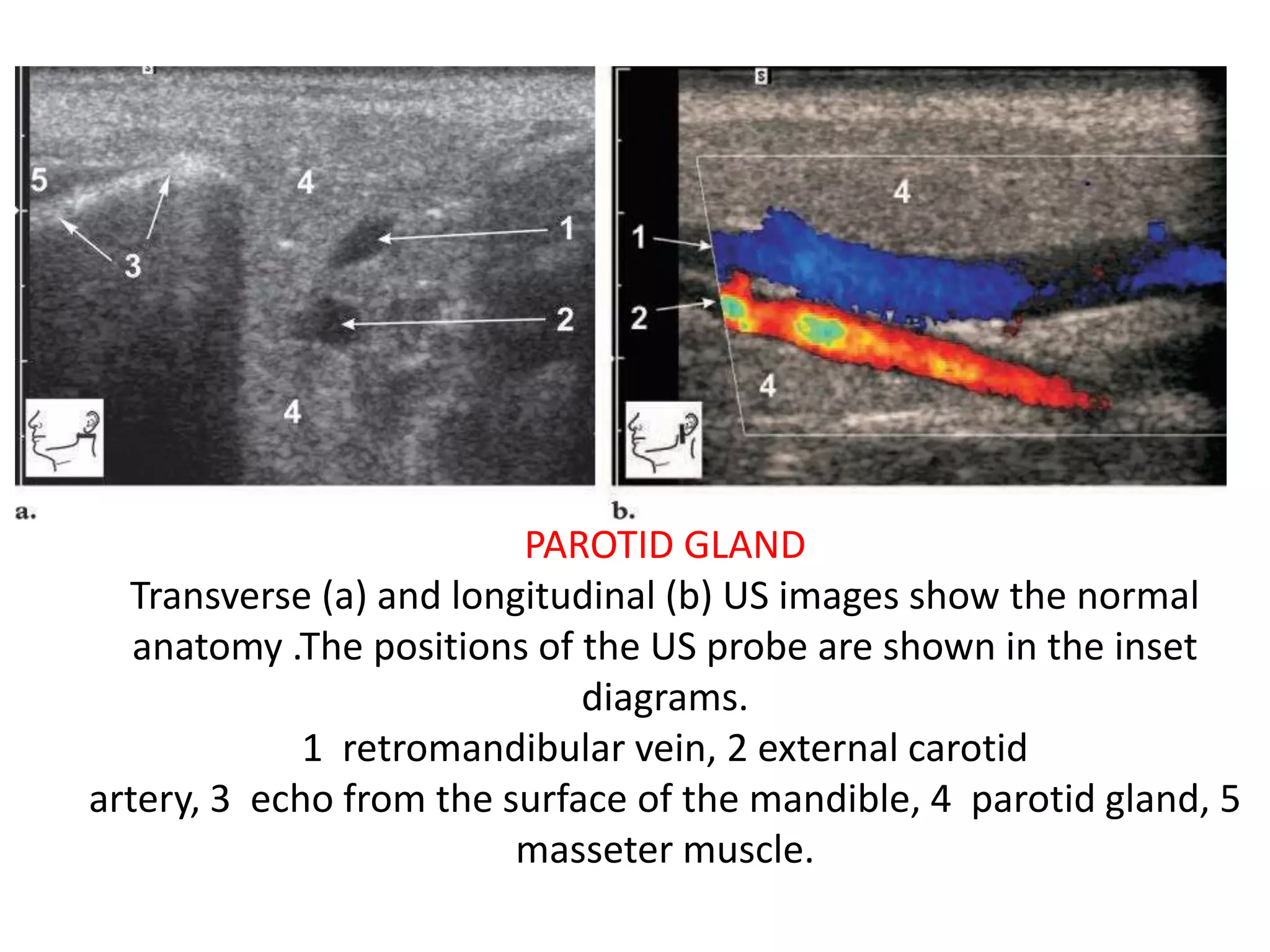 Ultrasound of salivary glands | PPTX