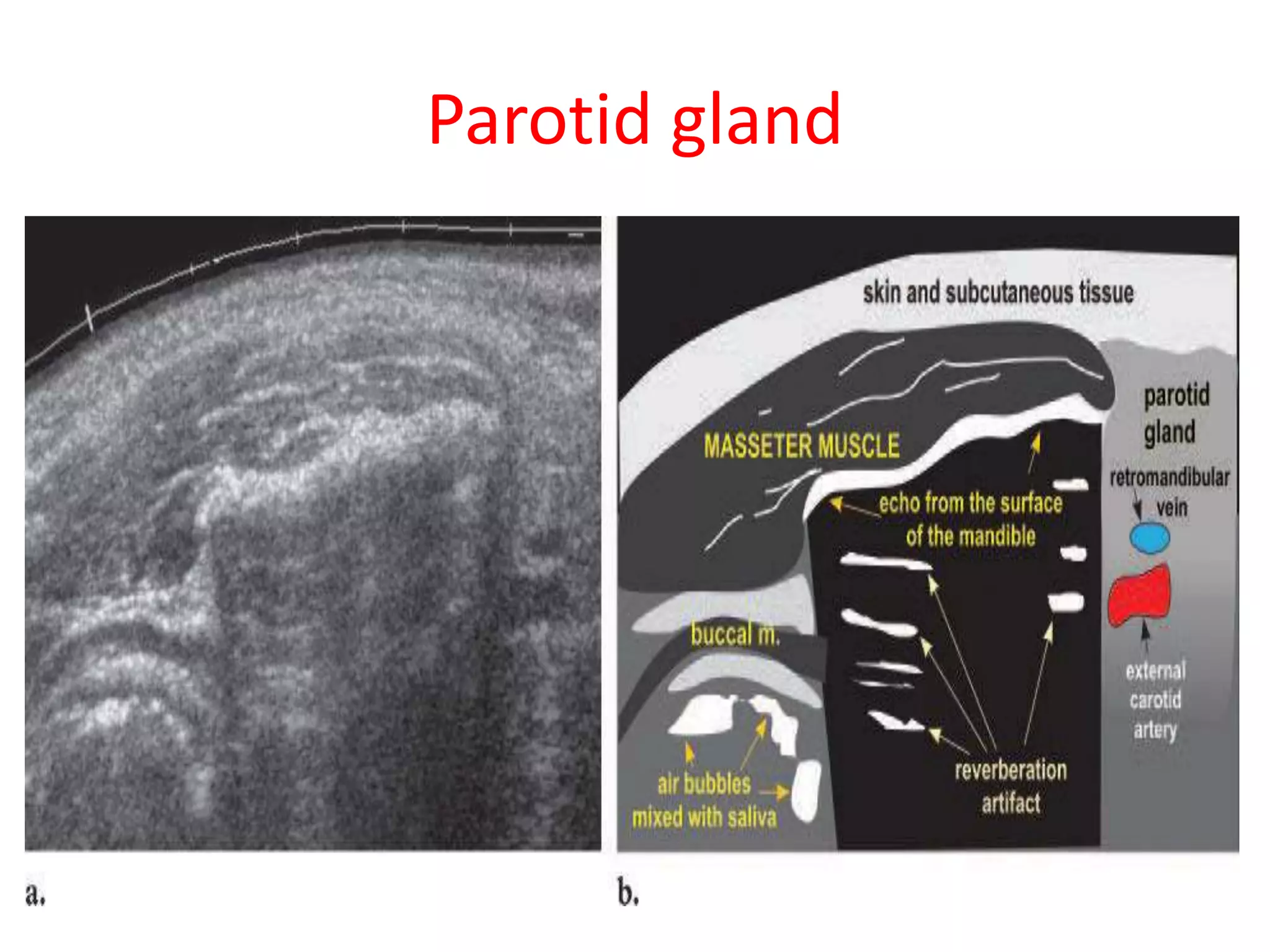 Ultrasound of salivary glands | PPTX