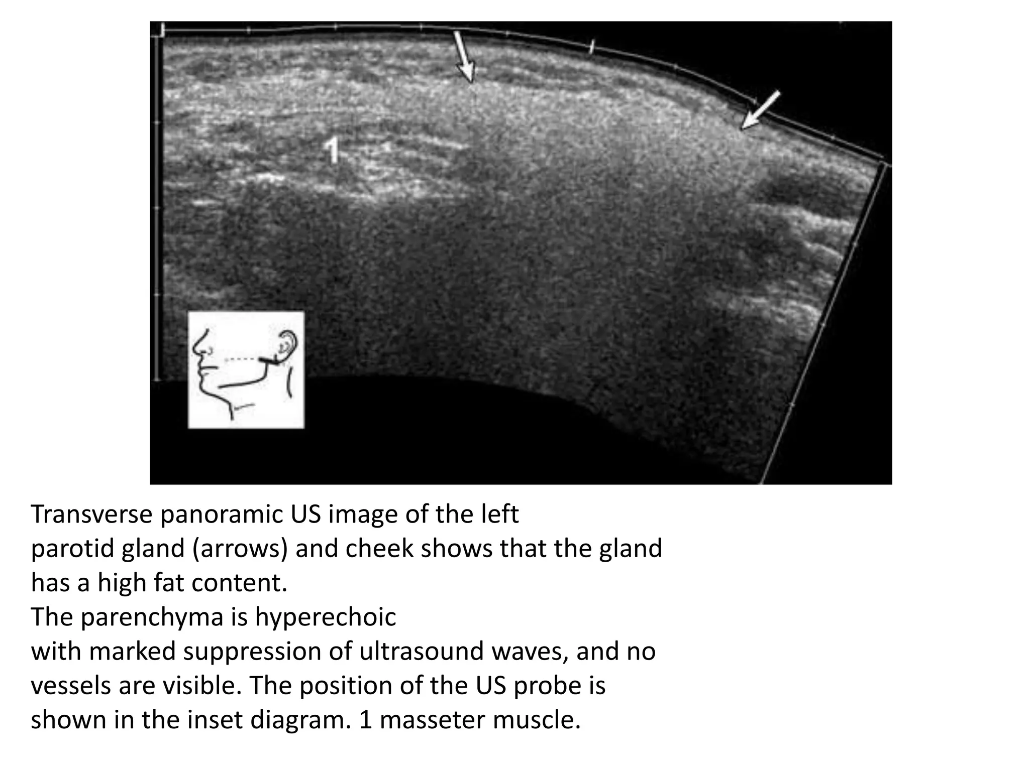 Ultrasound of salivary glands | PPTX