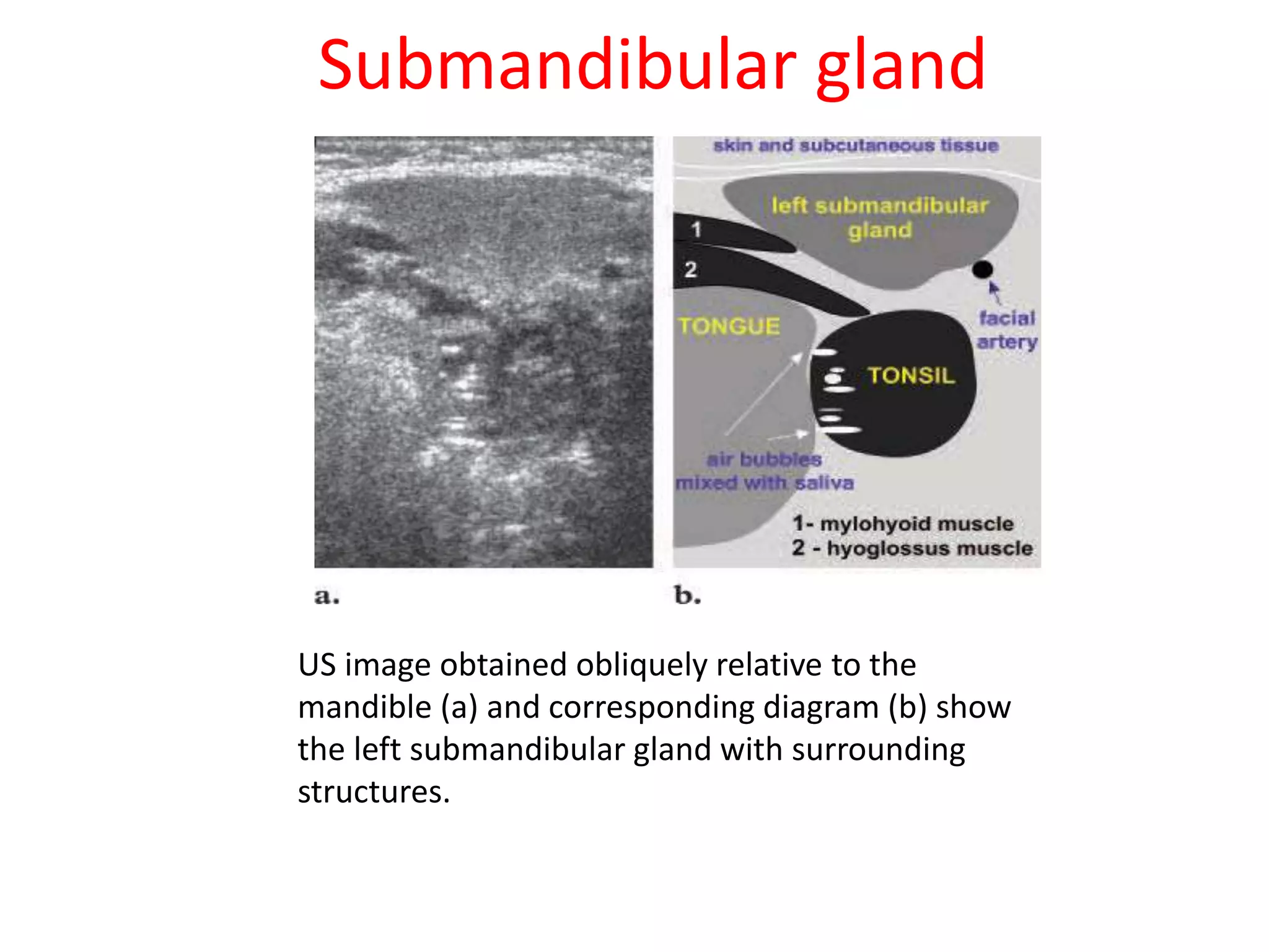 Ultrasound of salivary glands | PPTX