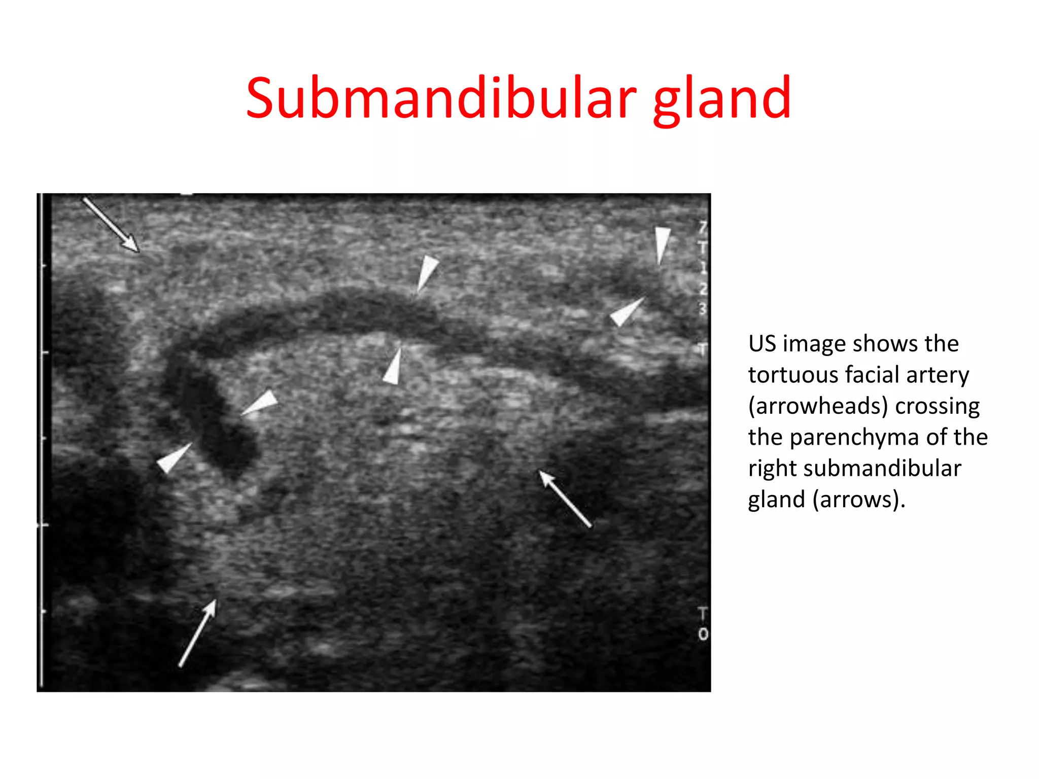 Ultrasound of salivary glands | PPTX