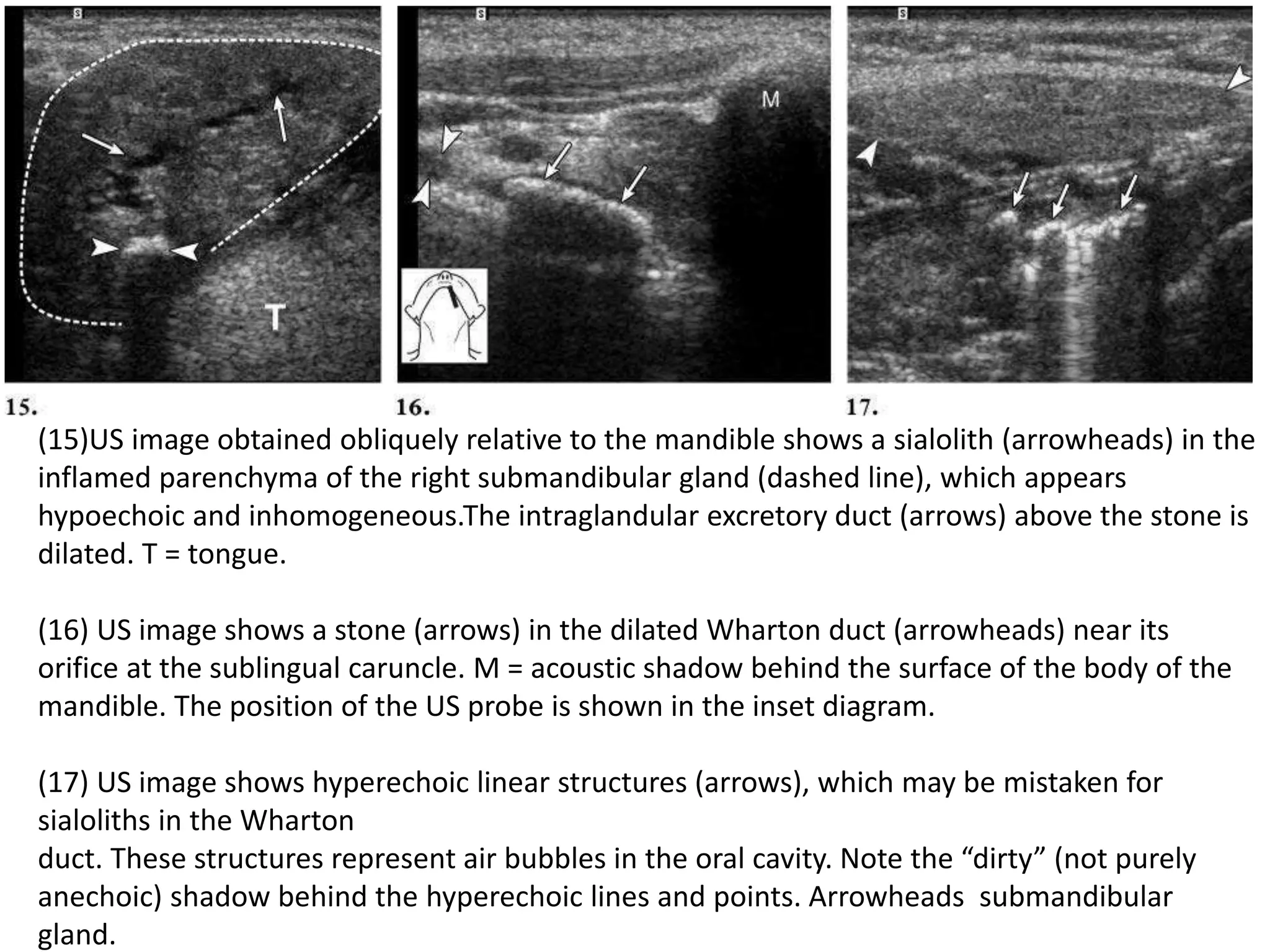 Ultrasound of salivary glands | PPTX