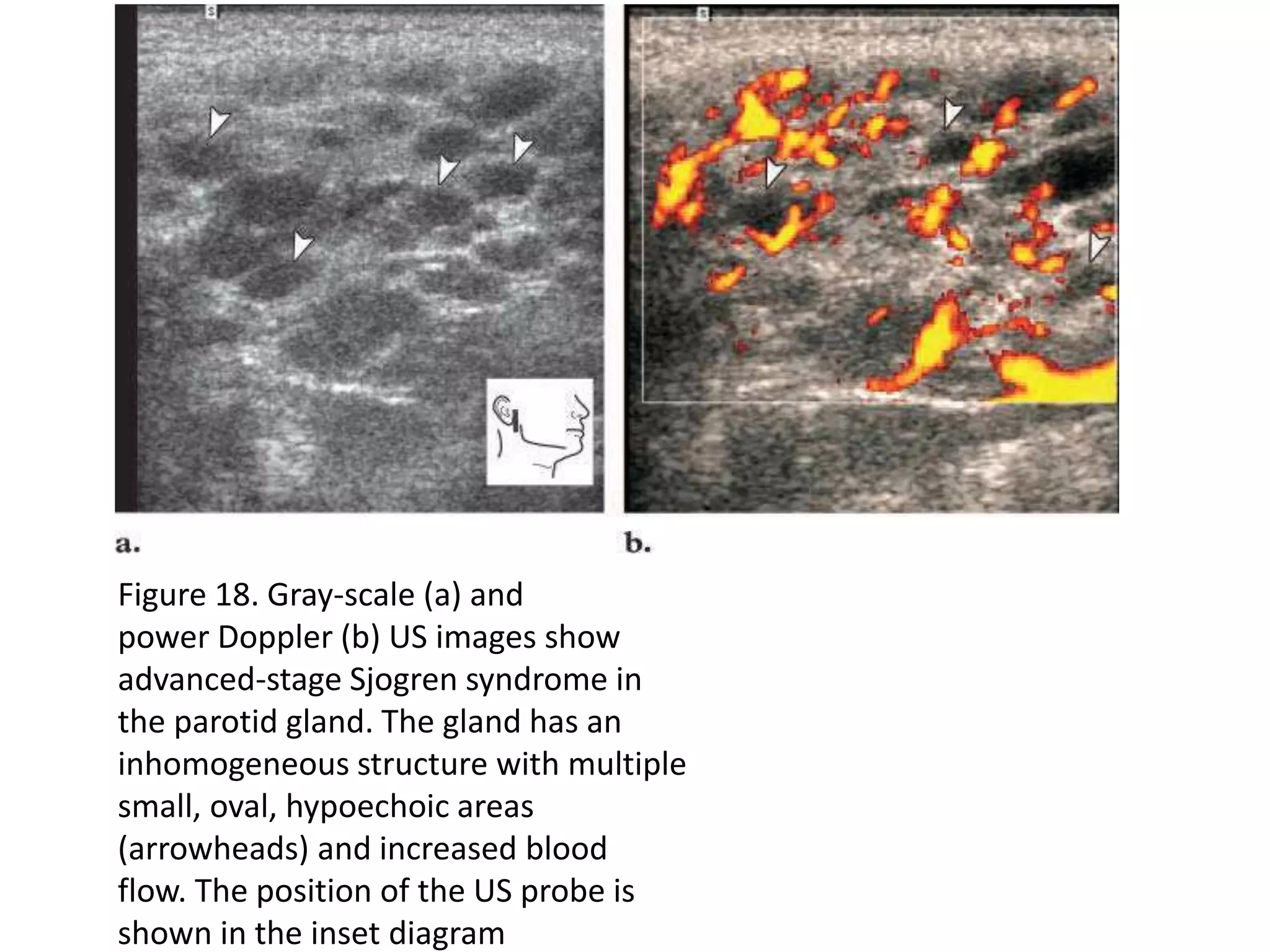 Ultrasound of salivary glands | PPTX