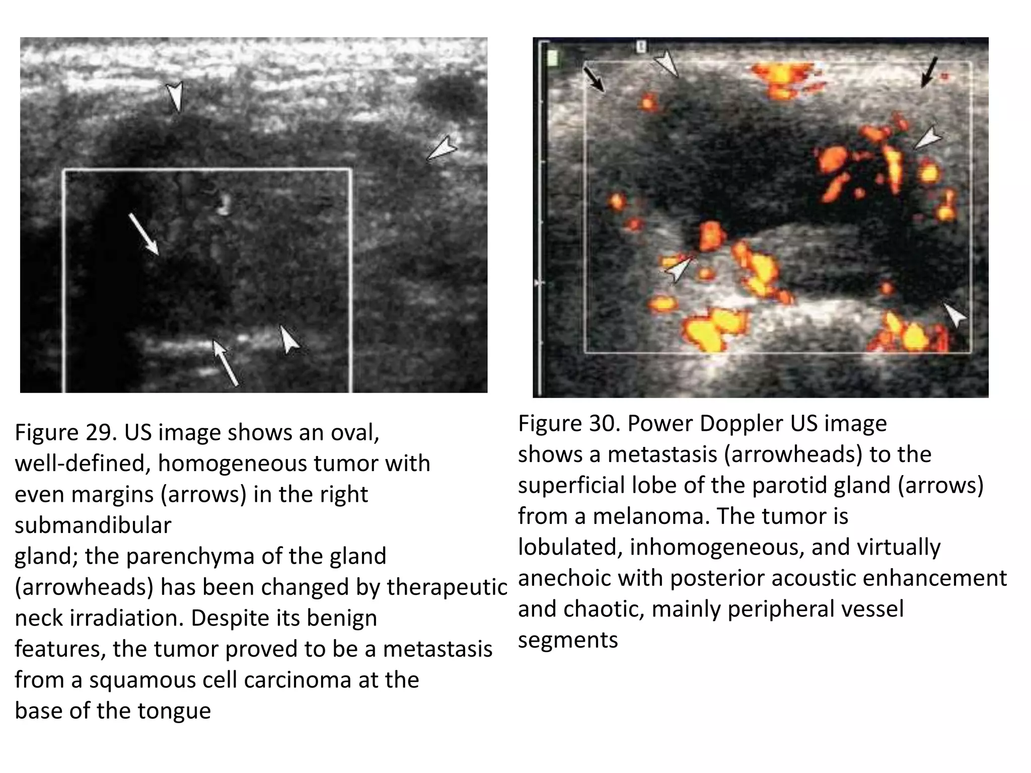 Ultrasound of salivary glands | PPTX