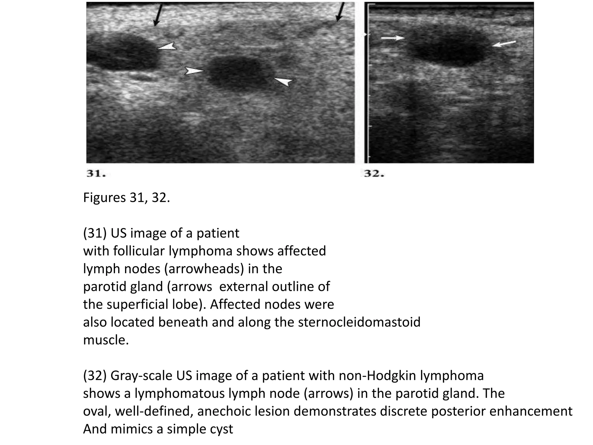 Ultrasound of salivary glands | PPTX