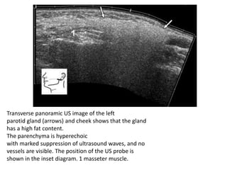 Ultrasound of salivary glands | PPTX