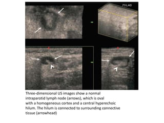 Ultrasound of salivary glands | PPTX