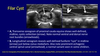 Conus Medullaris Ultrasound