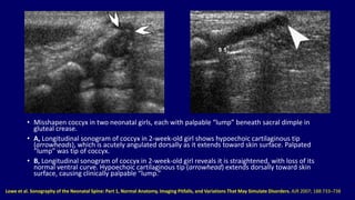 Sacral Dimple Ultrasound