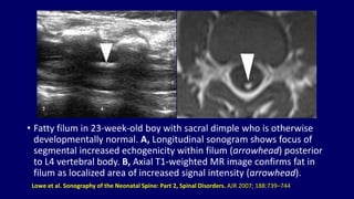 Sacral Dimple Ultrasound