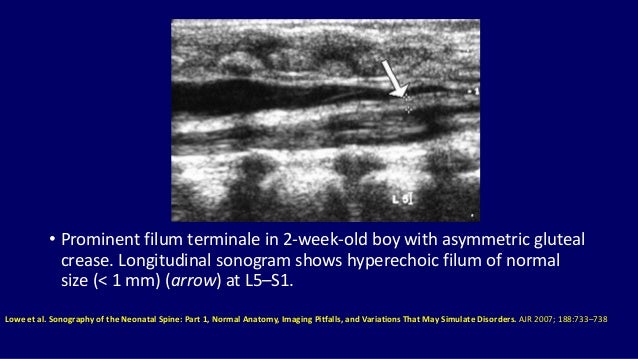 Ultrasound of spinal cord in neonates Dr. Muhammad Bin Zulfiqar