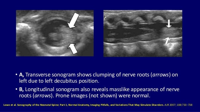 Ultrasound of spinal cord in neonates Dr. Muhammad Bin Zulfiqar