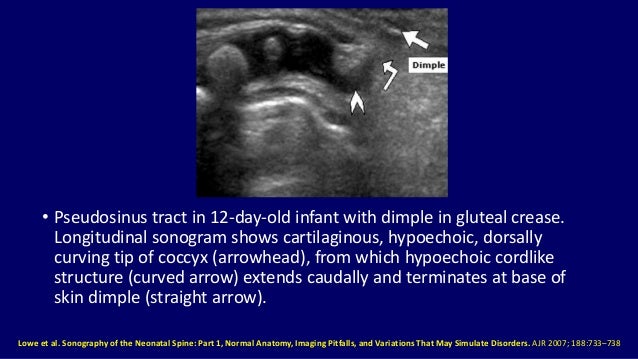Ultrasound of spinal cord in neonates Dr. Muhammad Bin Zulfiqar