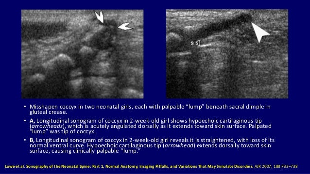 Ultrasound of spinal cord in neonates Dr. Muhammad Bin Zulfiqar
