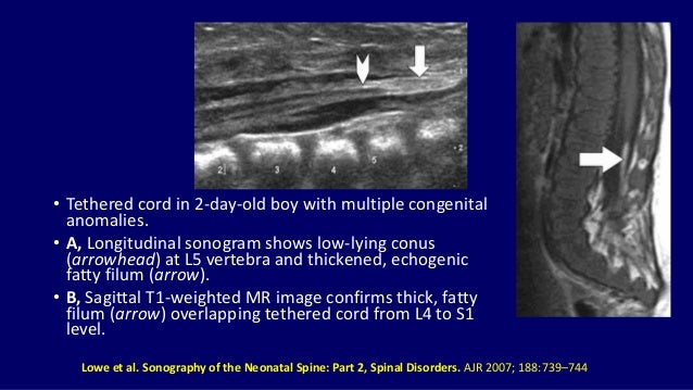 Ultrasound of spinal cord in neonates Dr. Muhammad Bin Zulfiqar