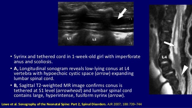 Ultrasound of spinal cord in neonates Dr. Muhammad Bin Zulfiqar
