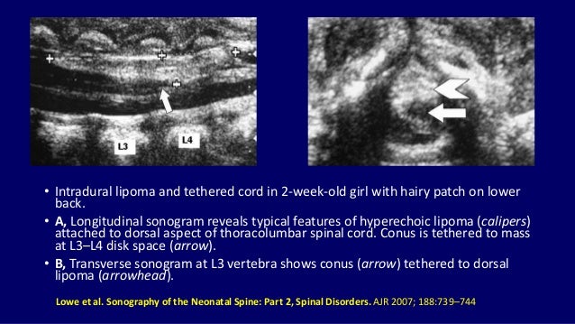 Ultrasound of spinal cord in neonates Dr. Muhammad Bin Zulfiqar